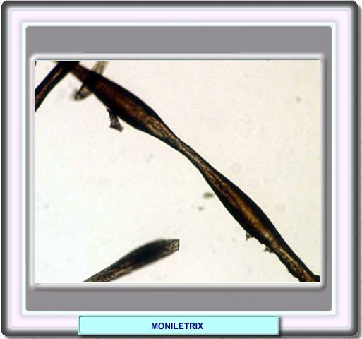 Monilethrix Pictures