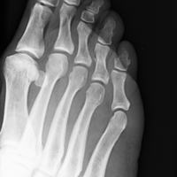 Calcaneus, ferde felvétele (Zadravecz-Brodén) - Képalkotás