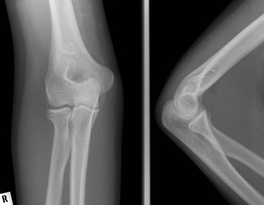 Könyök, kétirányú felvétel - 31720 - Képalkotás